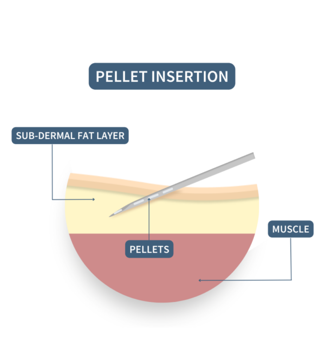 Evexias Hormone Pellet Therapy – Diabetes & Thyroid Metabolic Clinic